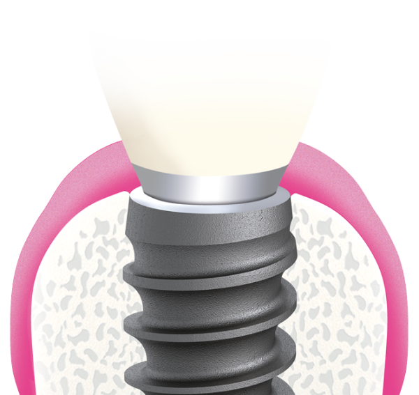 Switching Platform et Ostéointegration – Easy Implant